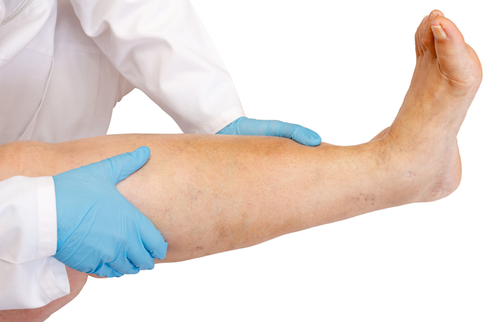 What causes a swollen leg? | Top Varicose Vein Treatment NYC